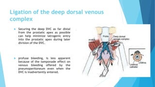 Robotic radical prostatectomy | PPTX