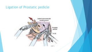 Robotic radical prostatectomy | PPTX