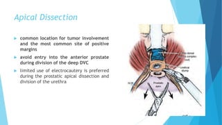 Robotic radical prostatectomy | PPTX