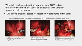 ROBOTICS IN ENT AND NEWLY ADAPTED TECHNIQUE | PDF