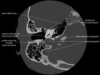 Anatomia Rocca TC - CT temporal bone anatomy | PPT