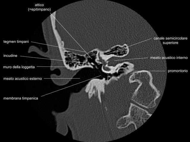 Anatomia Rocca TC - CT temporal bone anatomy