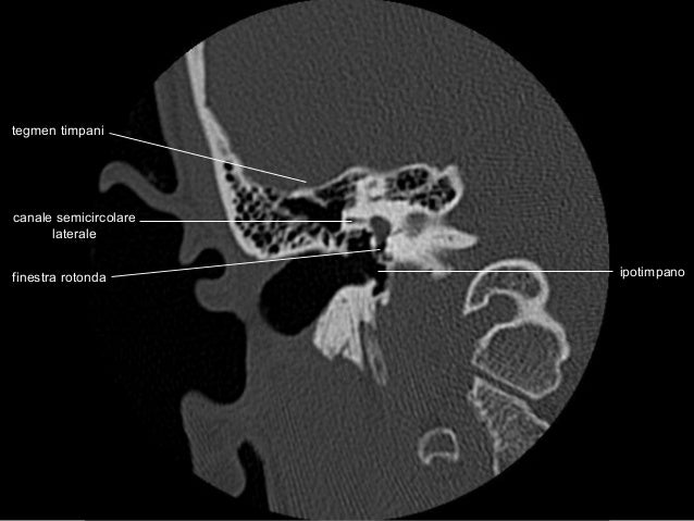 Anatomia Rocca TC - CT temporal bone anatomy