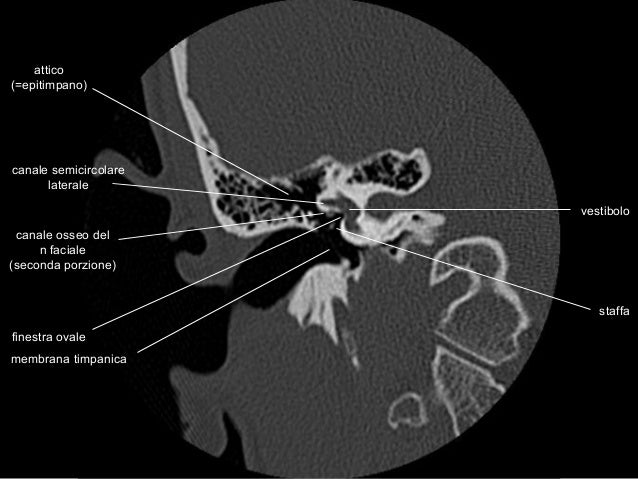 Anatomia Rocca TC - CT temporal bone anatomy