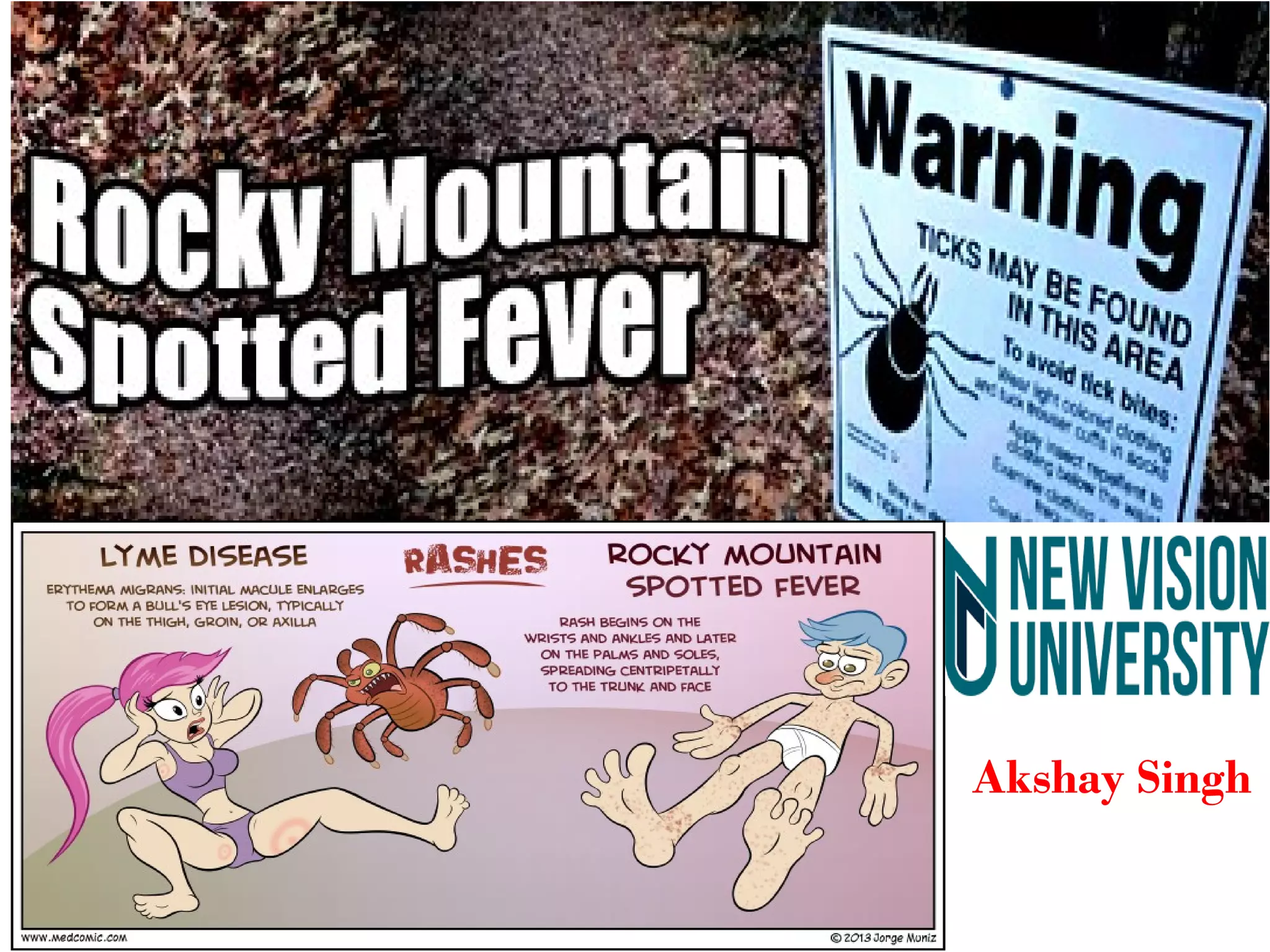 Rocky mountain spotted fever | PPT