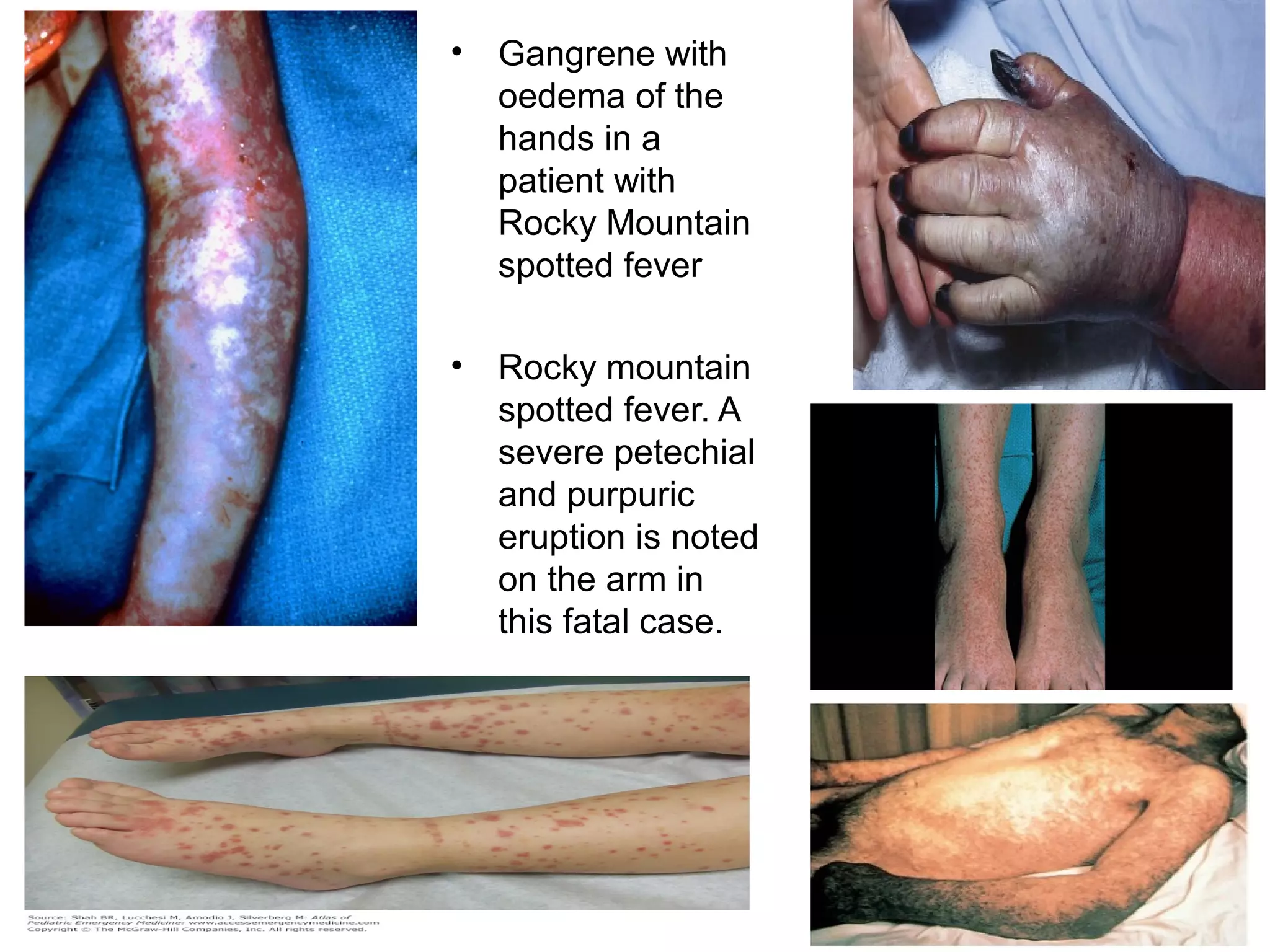 Rocky mountain spotted fever | PPT