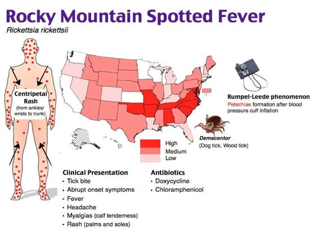 Rocky mountain spotted fever | PPT