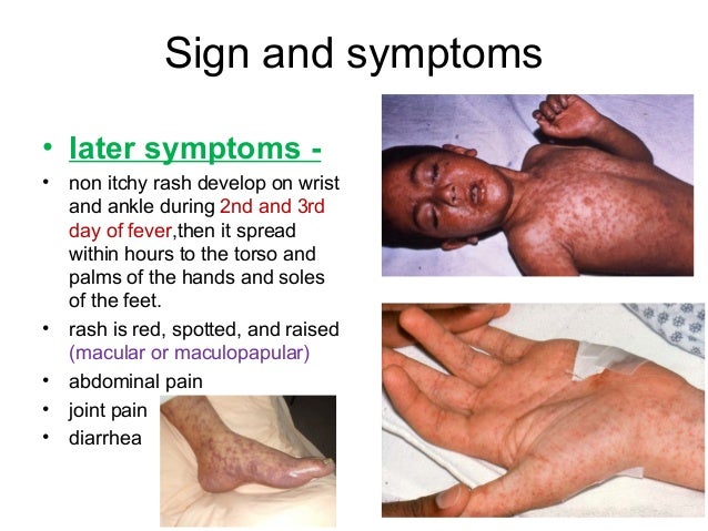 Rocky Mountain Spotted Fever Epidemiology