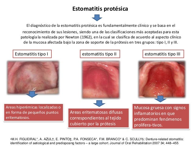 Que Es Estomatitis Subprotesica - ligar con maduritas