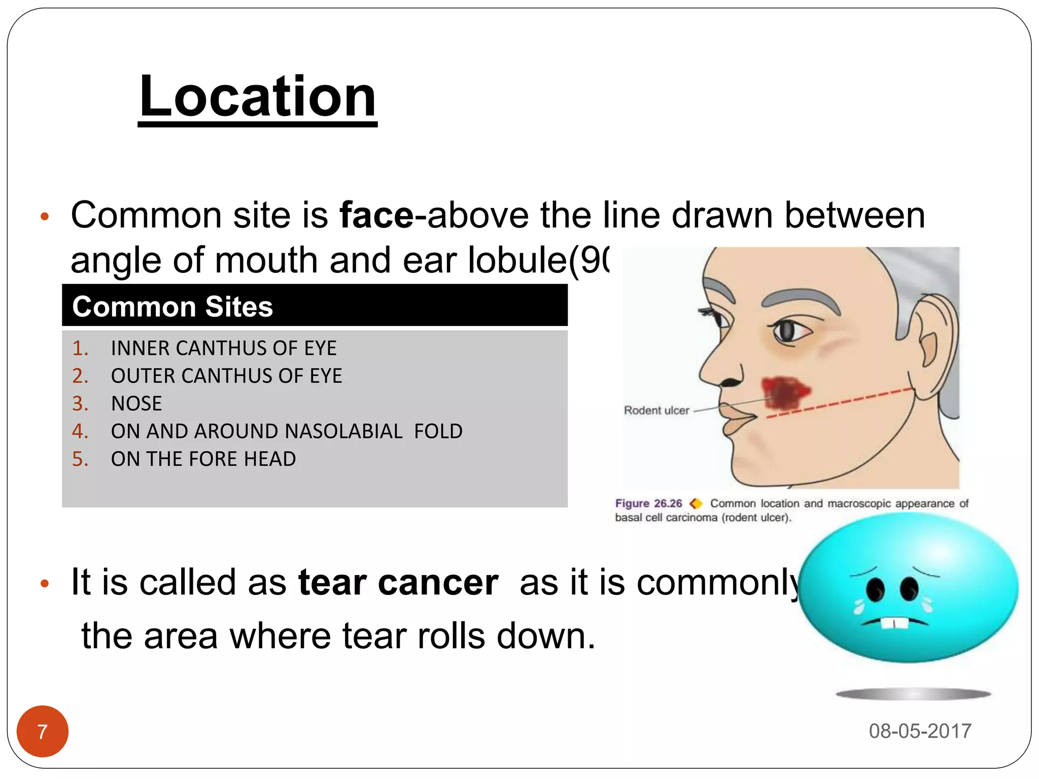 Rodent ulcer | PPTX