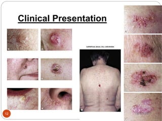 Rodent ulcer | PPTX | Skin and Dermatology | Diseases and Conditions