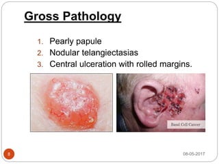 Rodent ulcer | PPTX | Skin and Dermatology | Diseases and Conditions