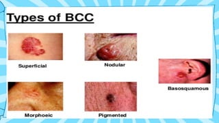 RODENT ULCER.pptx