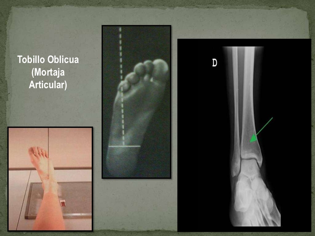 Proyecciones de Rodilla y Tobillo en Radiología Convencional
