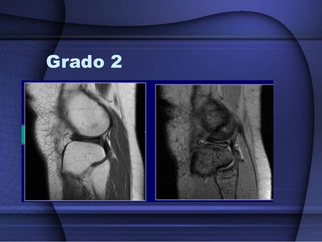 Resonancia Magnetica De Rodilla