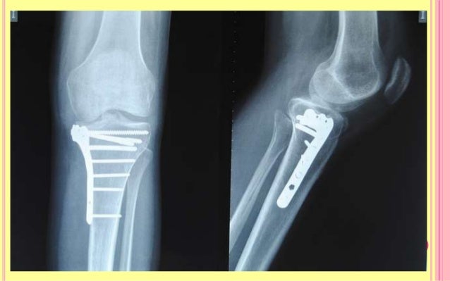 Xknee Startradiology Radiologa Fracturas Rodillas