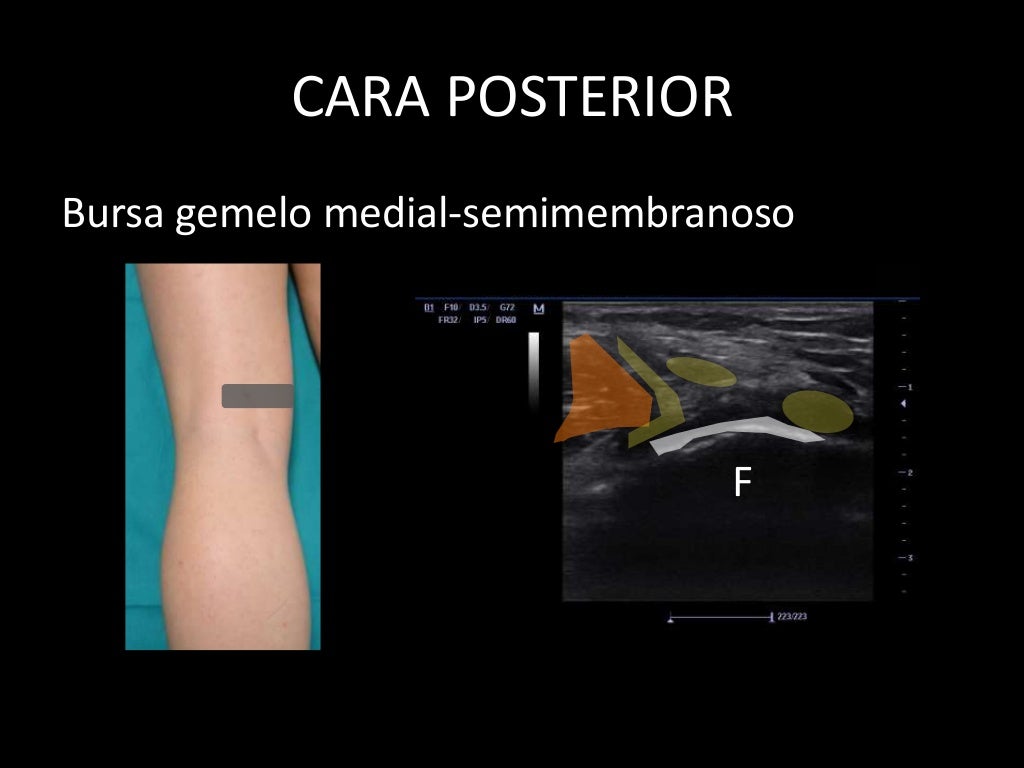 ANATOMÍA ECOGRÁFICA NORMAL DE LA RODILLA