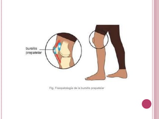 Rodilla | PPTX