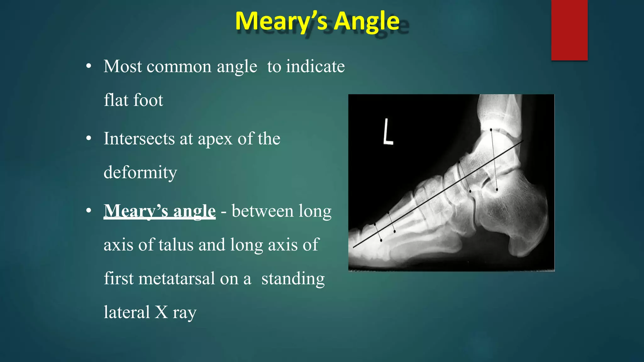 Flat Foot, Tibialis Posterior Tendon Dysfunction & Accessory ...