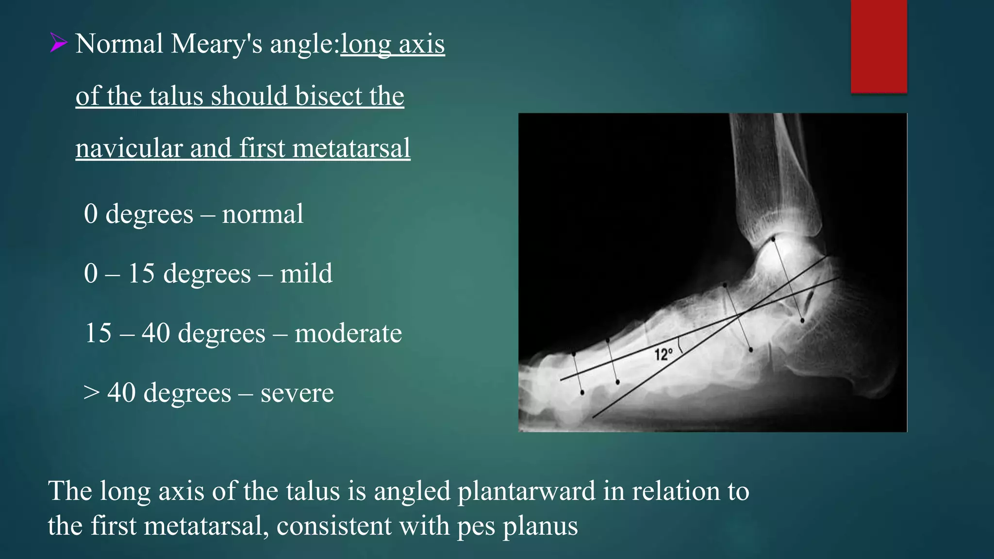 Flat Foot, Tibialis Posterior Tendon Dysfunction & Accessory ...