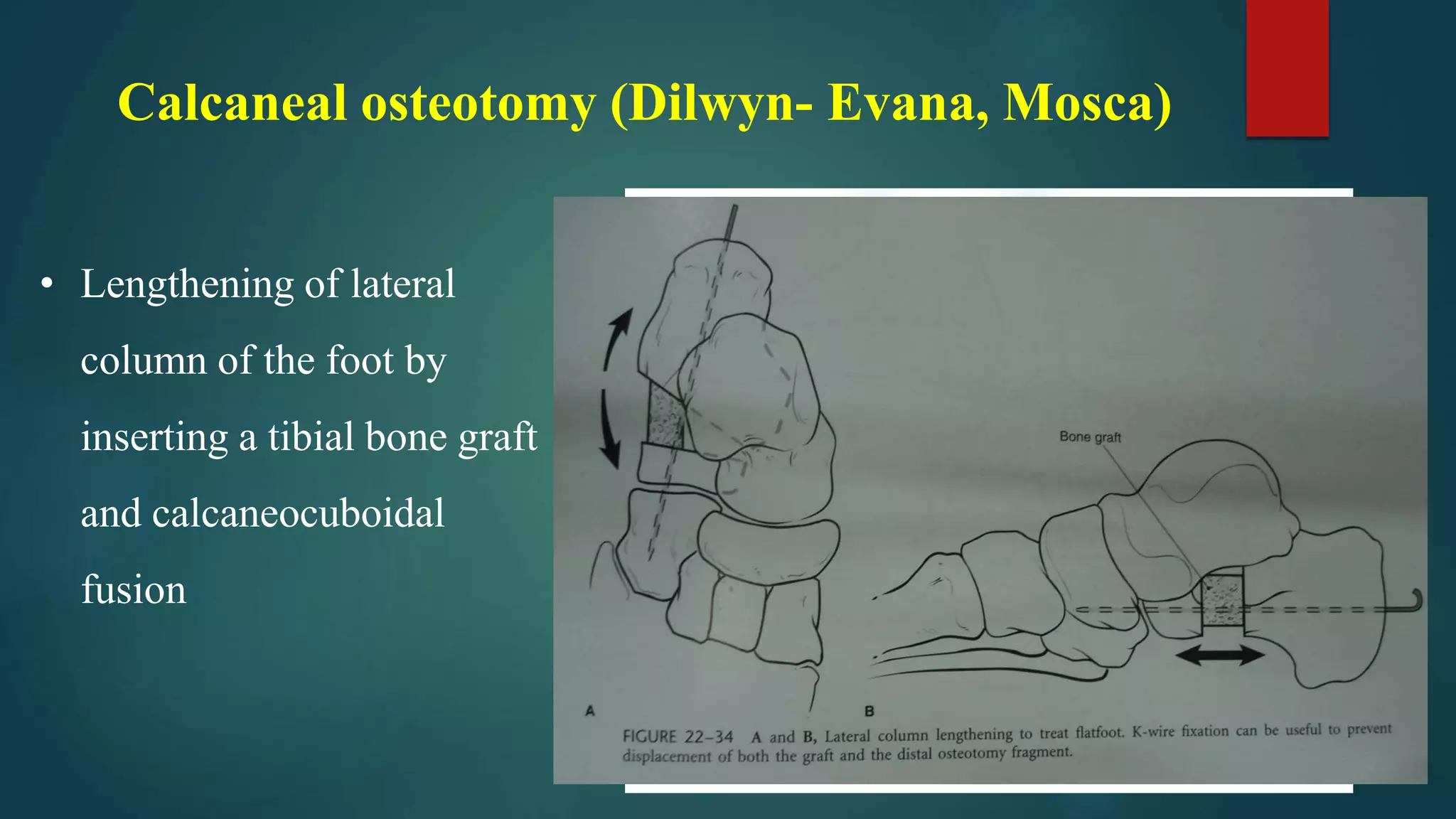 Flat Foot, Tibialis Posterior Tendon Dysfunction & Accessory ...