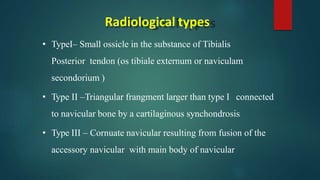 Flat Foot, Tibialis Posterior Tendon Dysfunction & Accessory ...