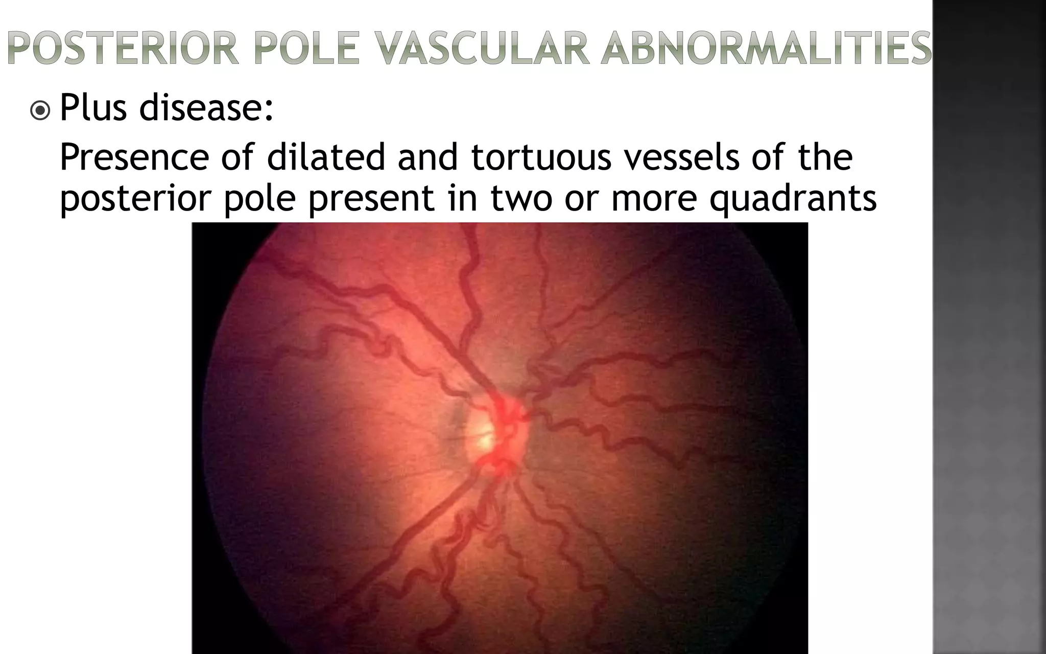 retinopathy of prematurity | PPTX