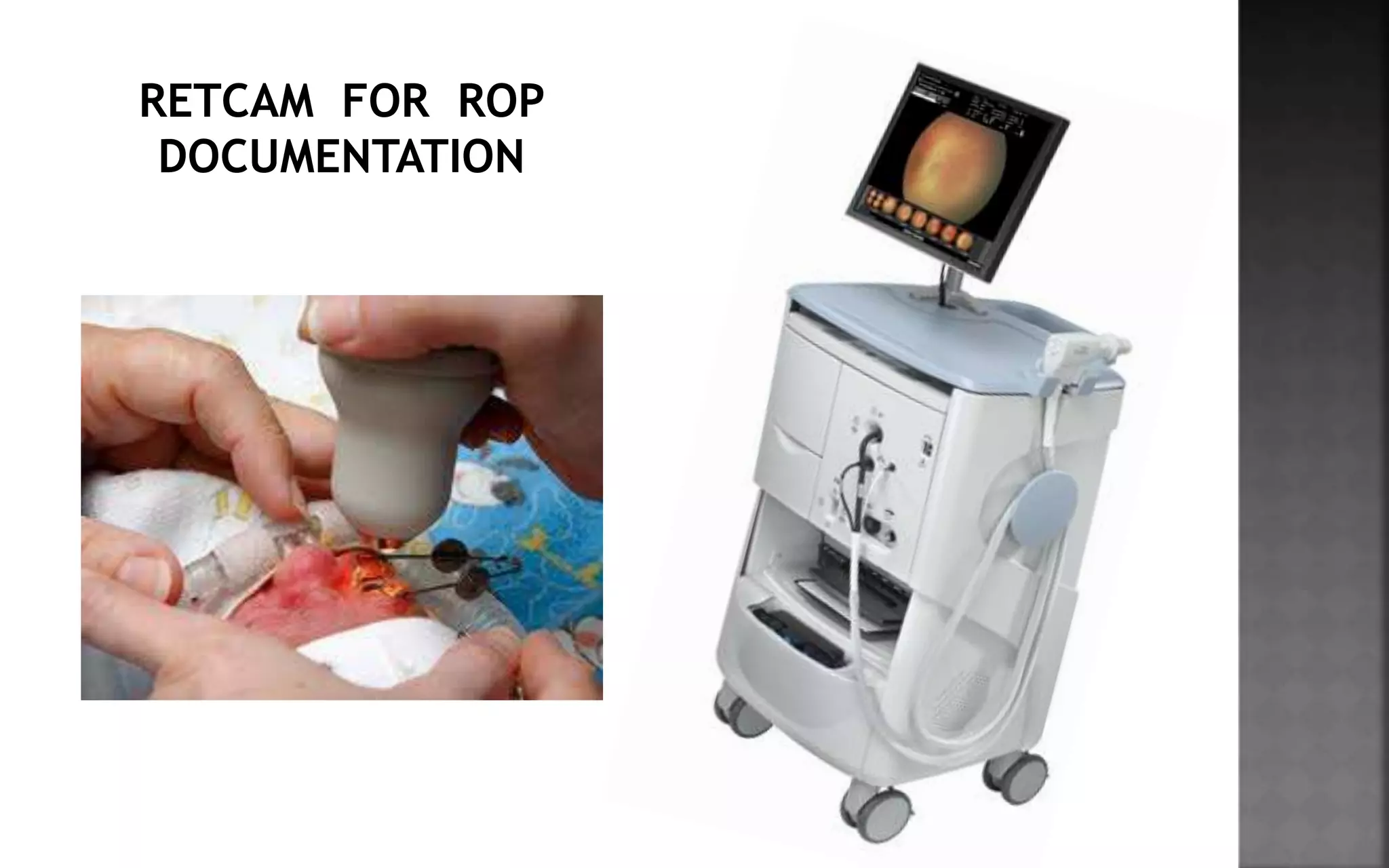 retinopathy of prematurity | PPTX