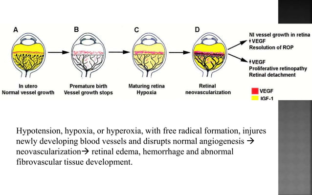 retinopathy of prematurity | PPTX | Eye and Vision Conditions ...