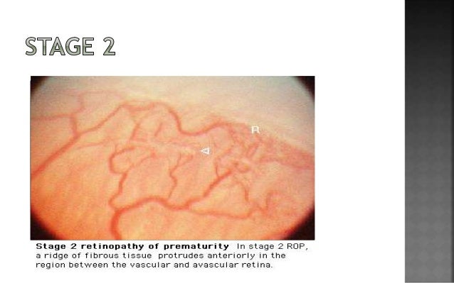 retinopathy of prematurity