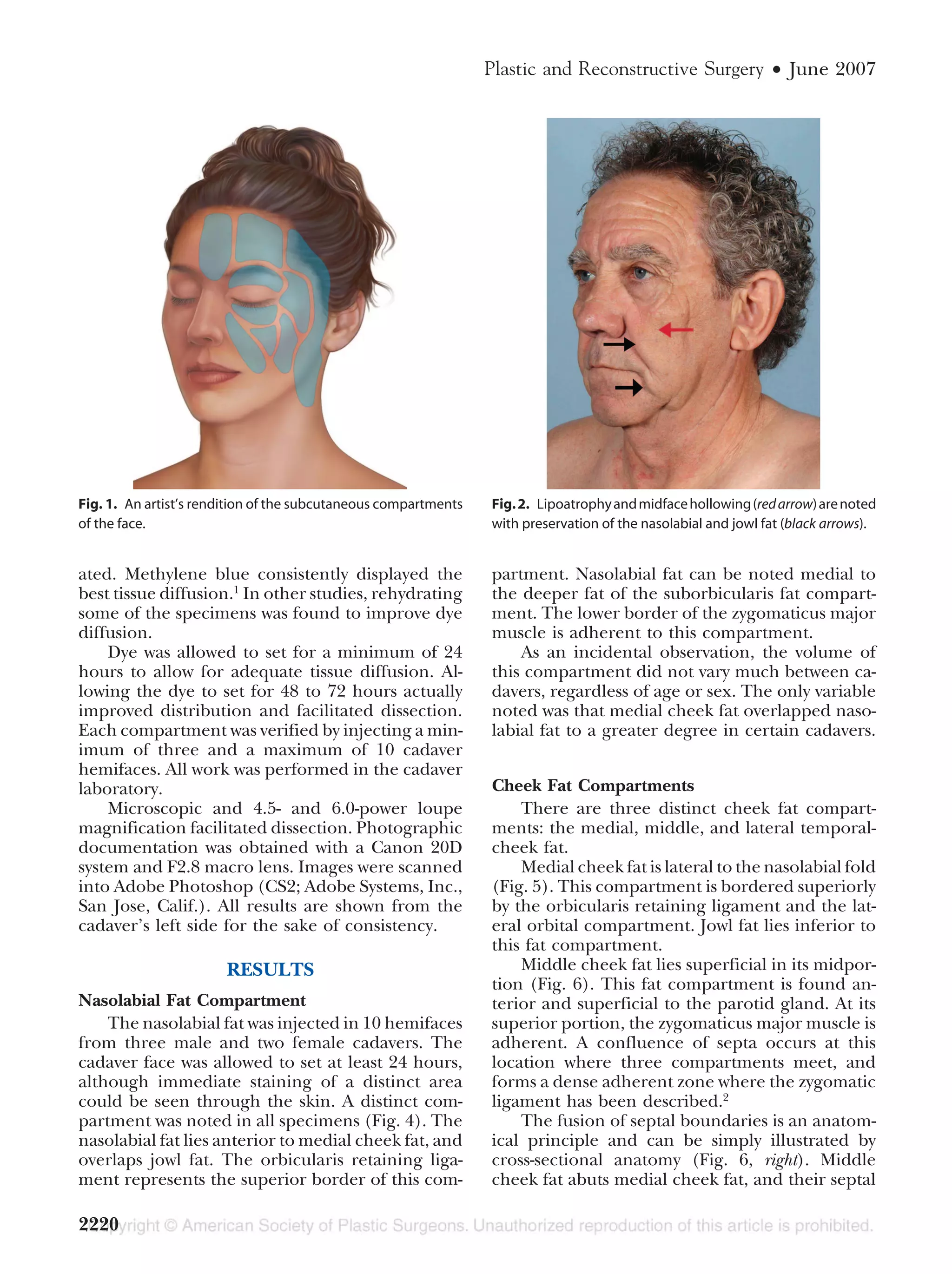 The fat compartments of the face- anatomy and clinical implications for ...