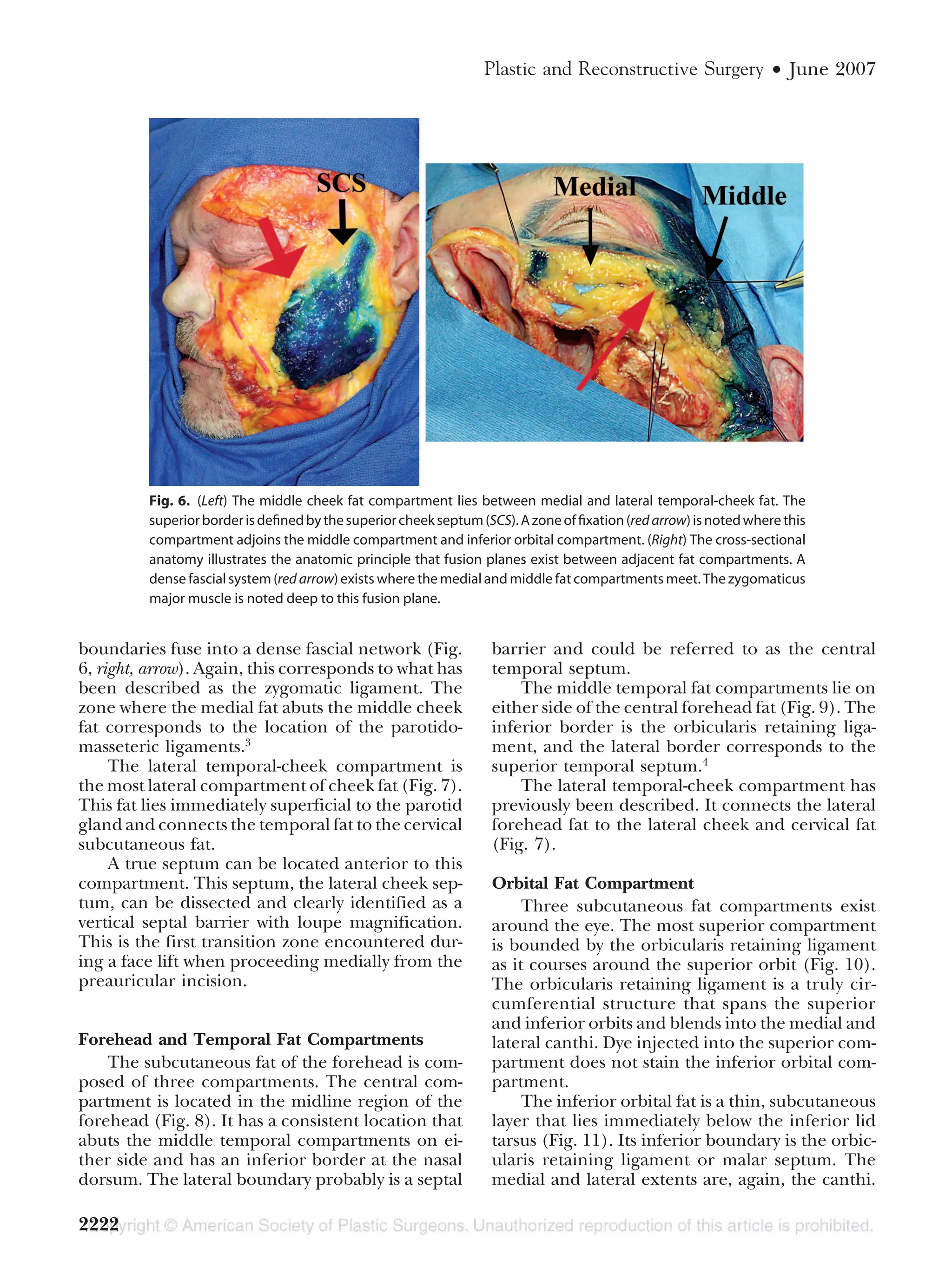 The fat compartments of the face- anatomy and clinical implications for ...