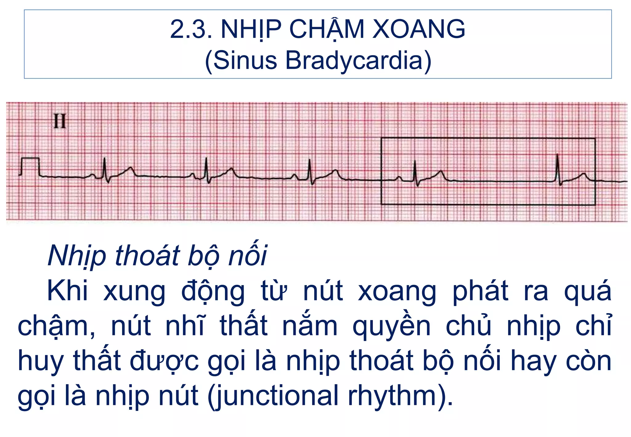 Rối loạn nhịp tim đánh giá qua điện tâm đồ | PDF