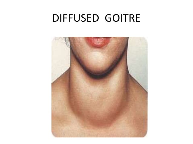 DIFFUSED GOITRE