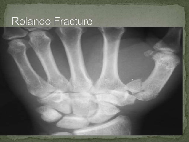 Rolando Fracture Power Point