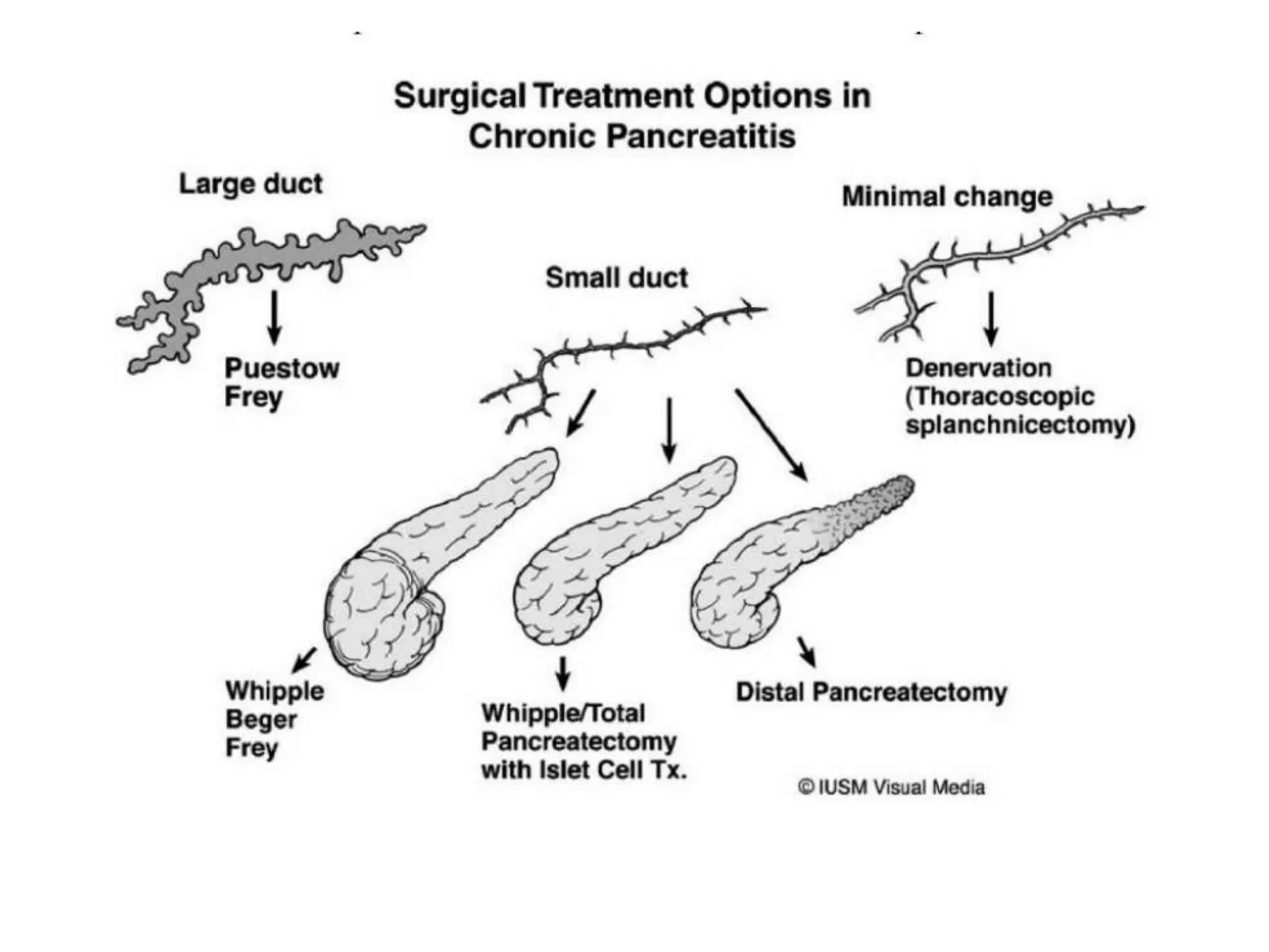 Role and types of surgery in chronic pancreatitis | PPTX