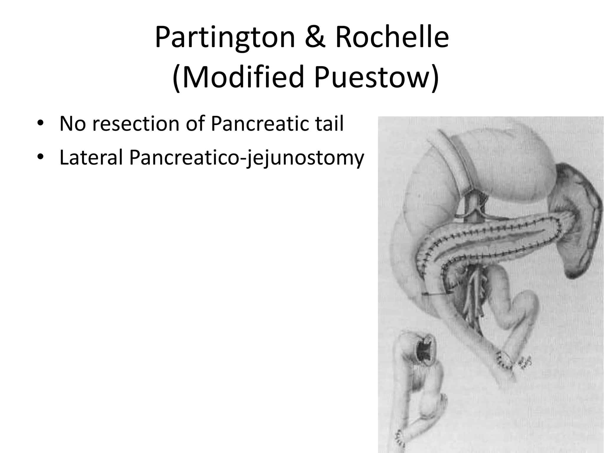 Role and types of surgery in chronic pancreatitis | PPTX