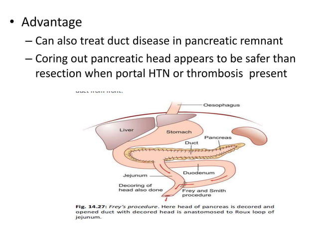 Role and types of surgery in chronic pancreatitis | PPTX | Digestive ...