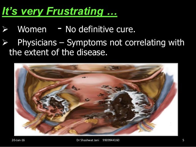 Role Of 2nd Look Laparoscopy In Endometriosis By Dr Shashwat Jani