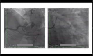 Role of 3rd Generation Water-Soluble Statin in Managing Dyslipidemia in ...