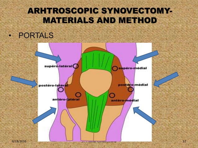 Role of arthroscopic synovectomy of knee joint in ra | PPTX | Surgery ...