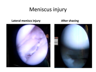 Role of arthroscopy | PPT