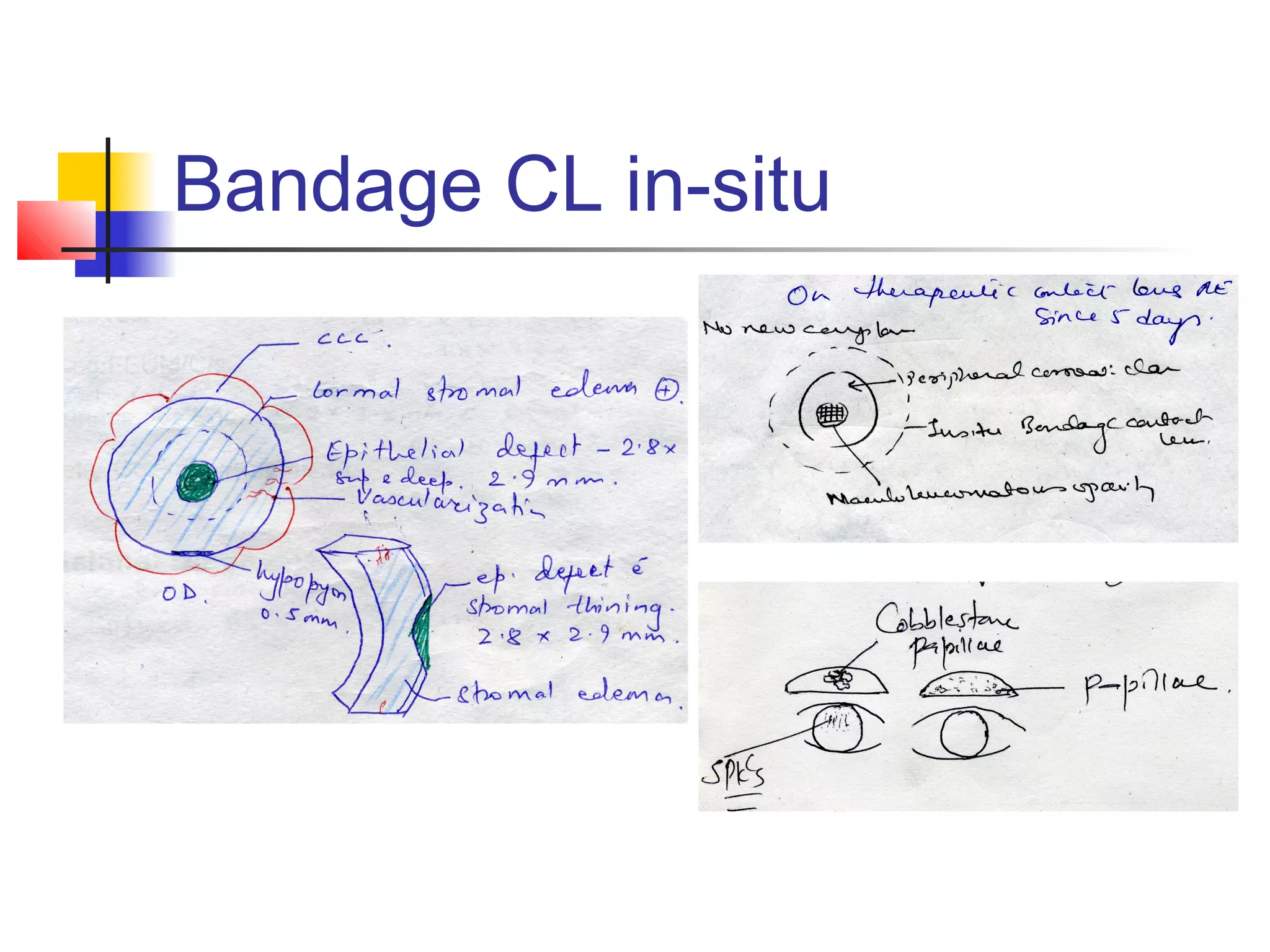 Role of bandage contact lens in corneal wound healing | PPT