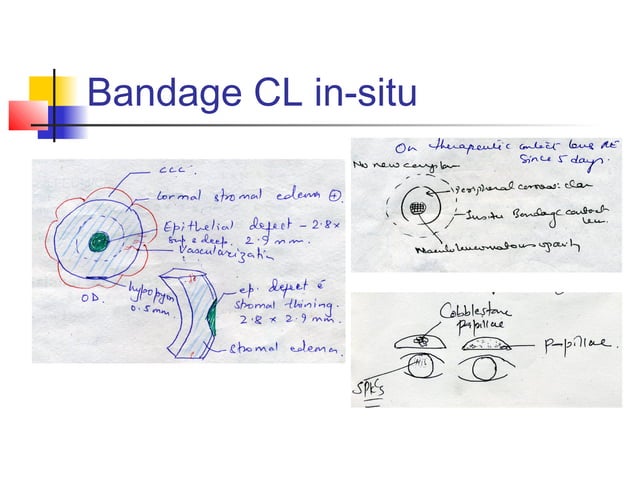 Role of bandage contact lens in corneal wound healing | PPT | Eye and ...