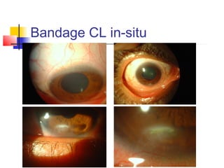 Role of bandage contact lens in corneal wound healing | PPT