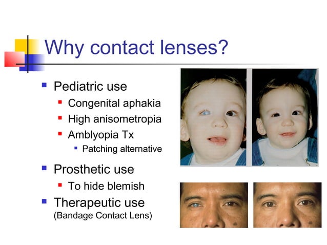 Role of bandage contact lens in corneal wound healing | PPT | Eye and ...