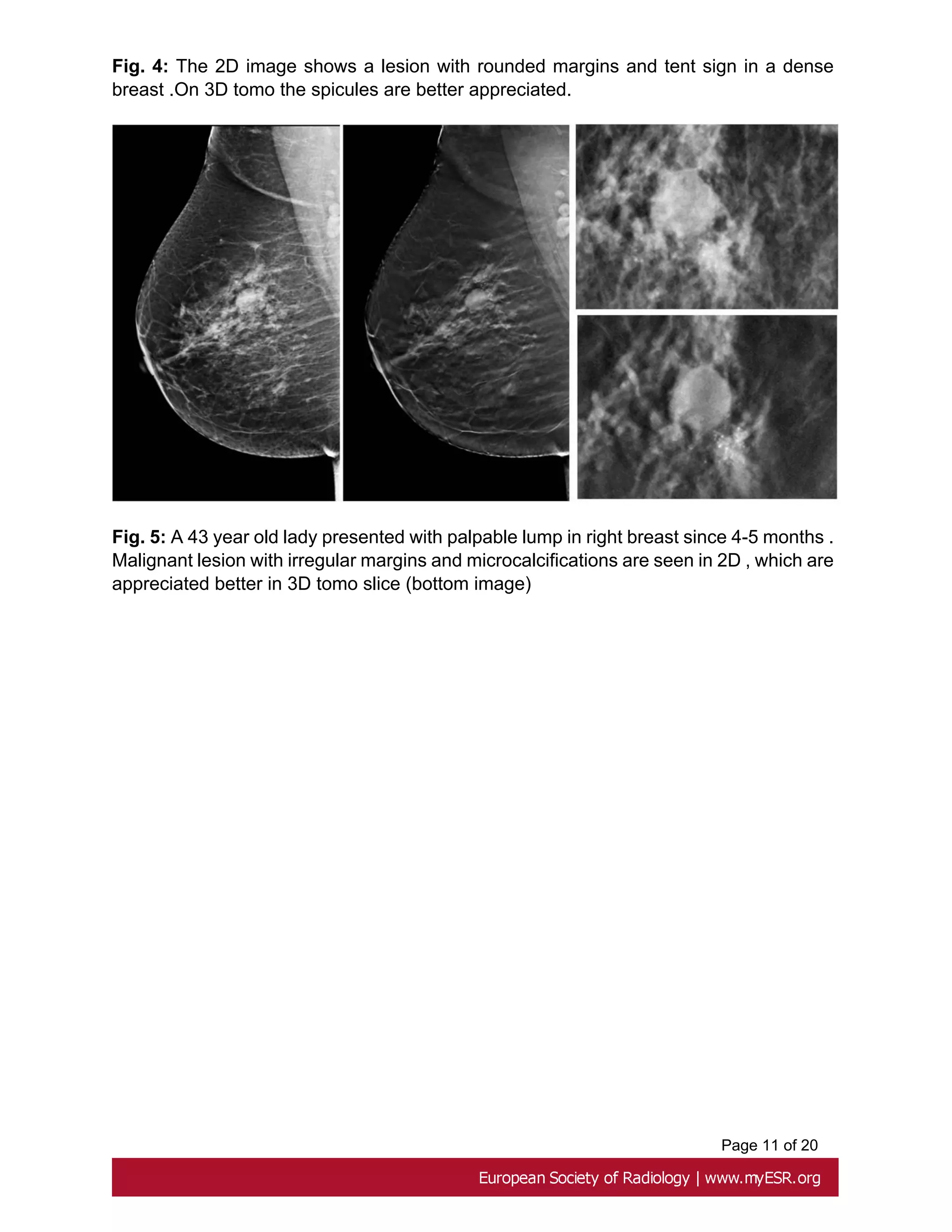 Role of Breast Tomosynthesis in the Morphological Analysis of Breast ...