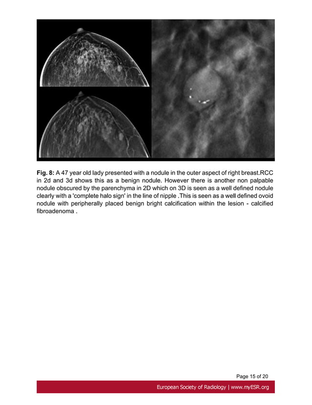 Role of Breast Tomosynthesis in the Morphological Analysis of Breast ...