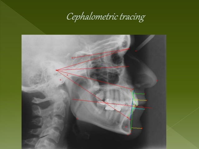 Role of cephalometry and panoramic radiographs in orthodontics. | PPTX ...