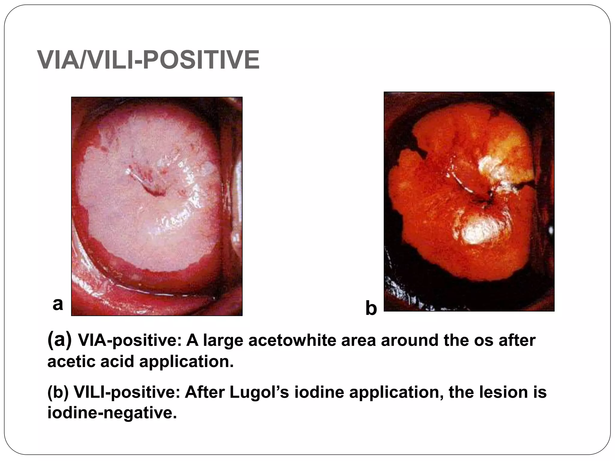 Role of cervical cancer screening in identifying untreated chronic ...